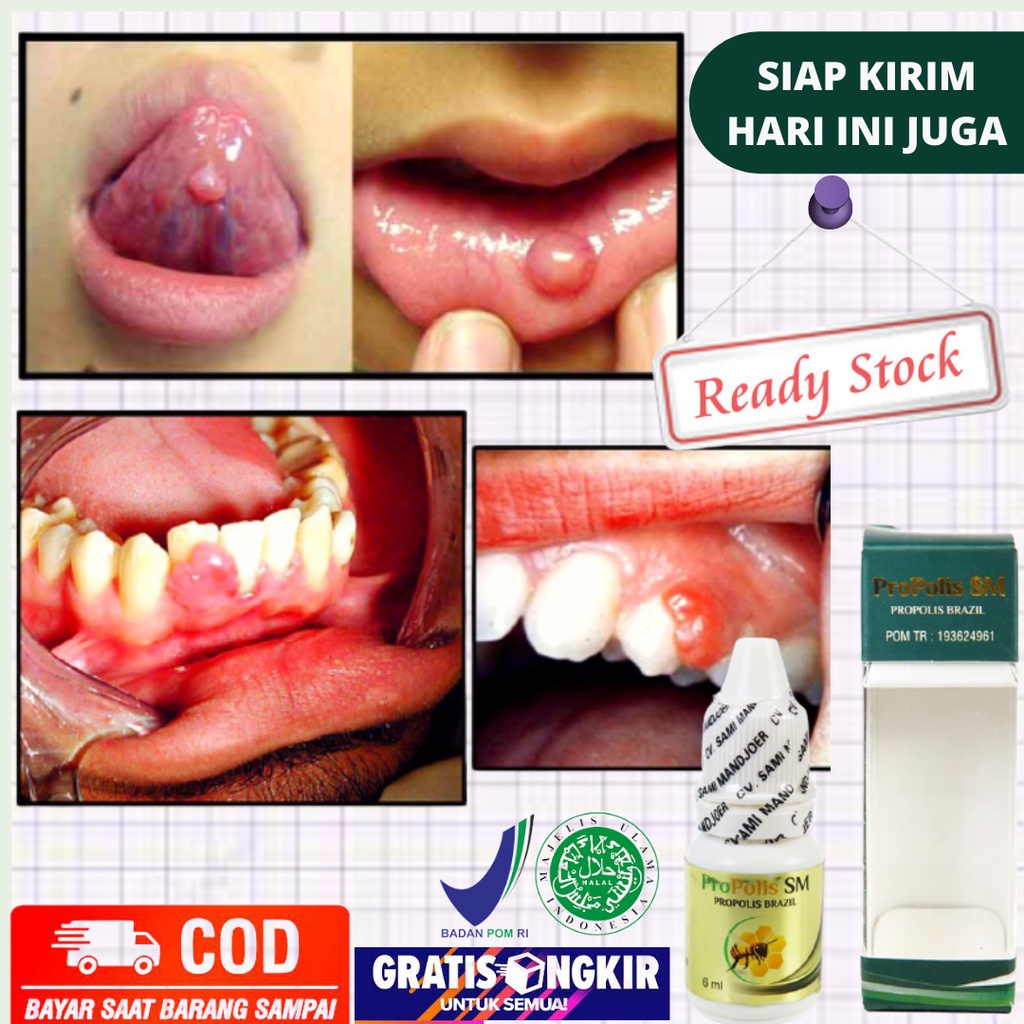 Jual obat benjolan - obat kista - Obat Herbal - Benjolan lidah ...