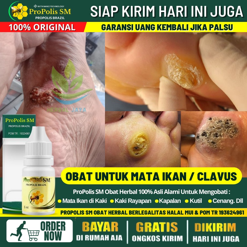 Jual Obat Mata Ikan Menahun di Telapak Kaki - Obat Untuk Melenyapkan Mata Ikan - Salep Mata Ikan ...