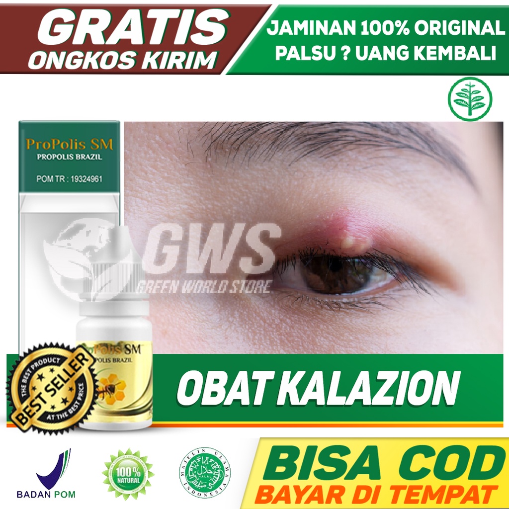 Jual Propolis Obat Benjolan Kalazion, Benjolan Kelopak Mata Bernanah ...