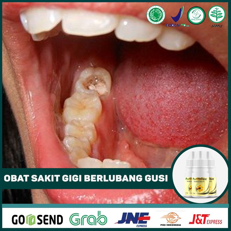 Jual Obat Sakit Gigi Berlubang, Penghancur Gigi Berlubang Dan Gusi Propolis SM 100% Asli Di ...