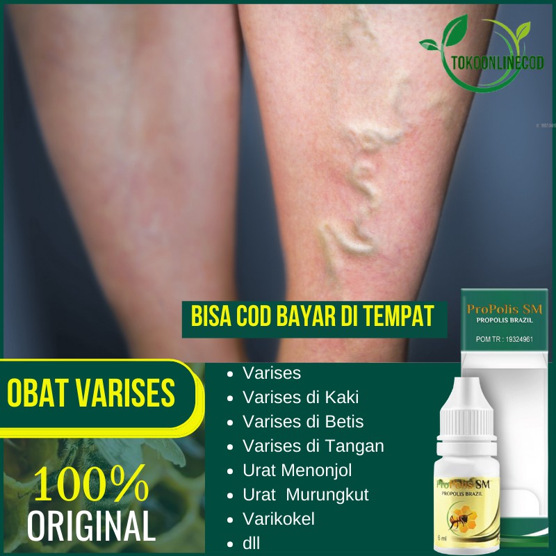 Jual Obat Varises, Varises di Kaki dan Betis, Varikokel, Urat Menonjol ...