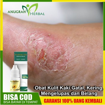 Jual Obat Kulit Kaki Gatal, Kering, Mengelupas dan Belang | Herbal ...