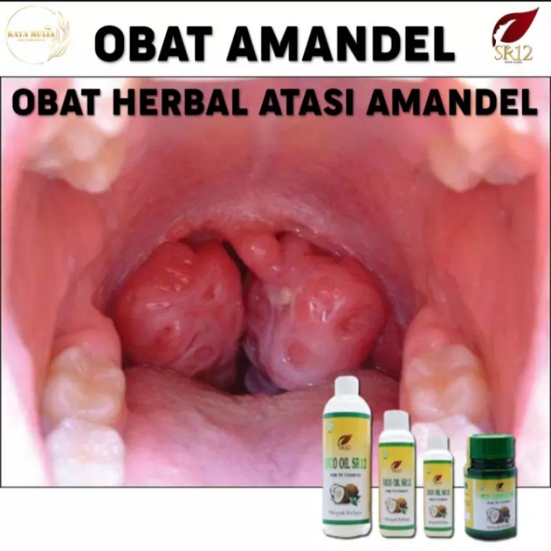 Jual OBAT AMANDEL PALING AMPUH/ VCO SR12/ OBAT AMANDEL UNTUK ANAK & DEWASA | Shopee Indonesia