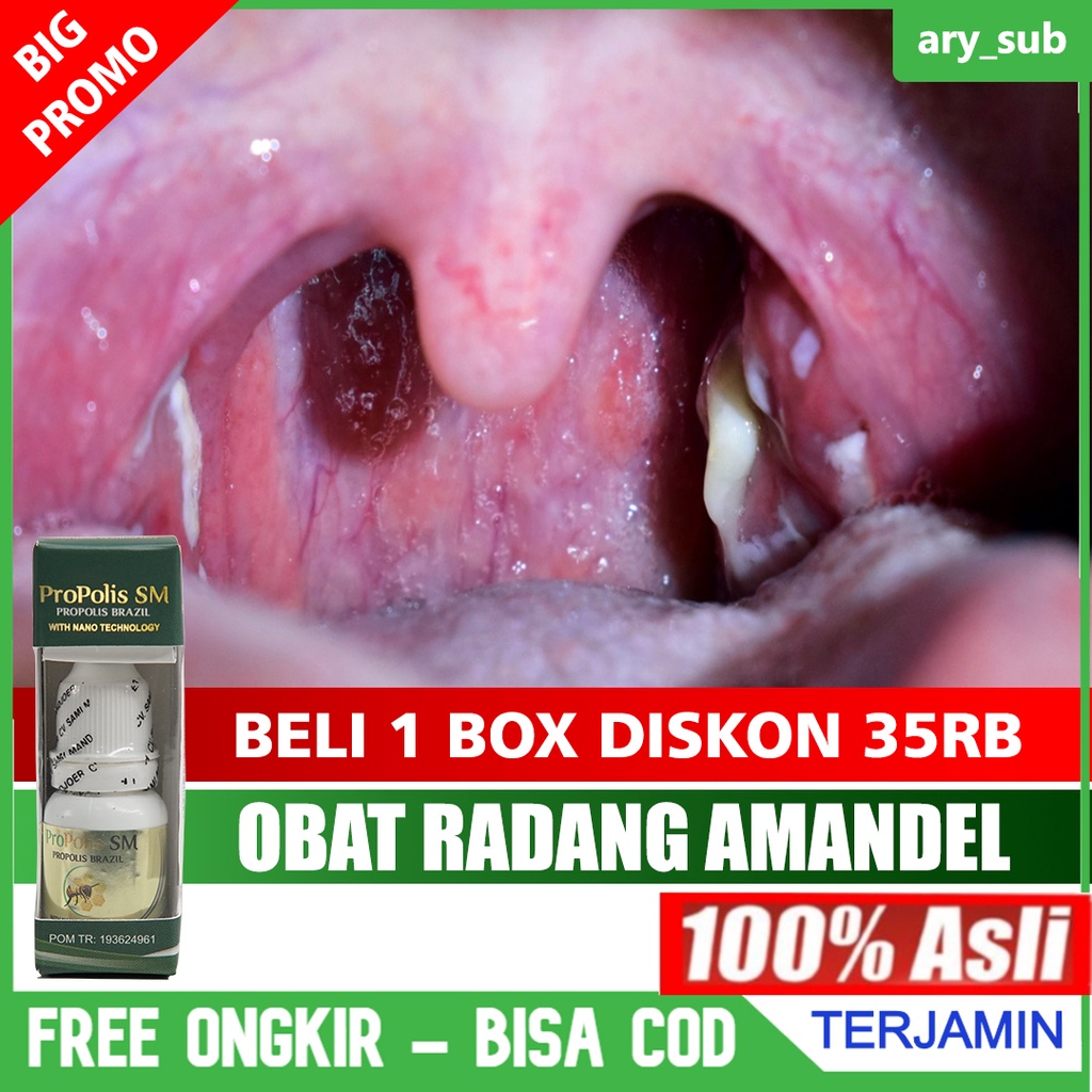 Jual Obat Radang Amandel Sakit Tenggorokan Leher Gatal Sakit Sulit Untuk Menelan Panas Dalam ...