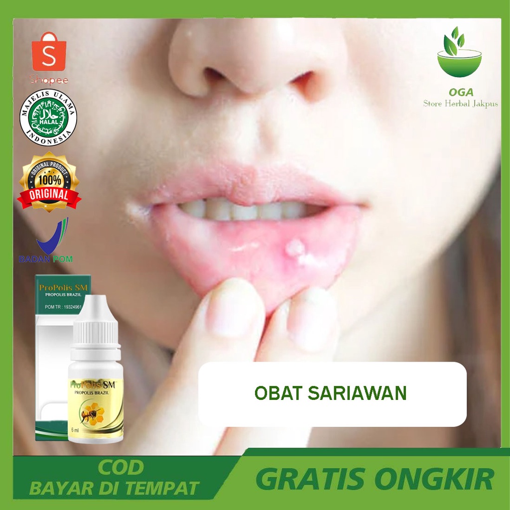 Jual Obat Sariawan Bakteri Mulut Luka di mulut dan lidah gusi meradang ...