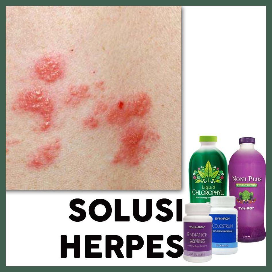 Jual Herbal Mengatasi Herpes / Dompo / Cacar Ular With Noni Plus dll ...