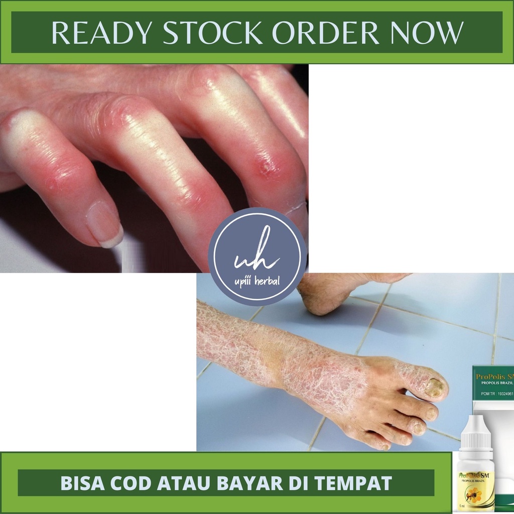Jual OBAT ALAMI SKLERODERMA, SKLORESIS SISTEMIK, OBAT KULIT MENGERAS ...