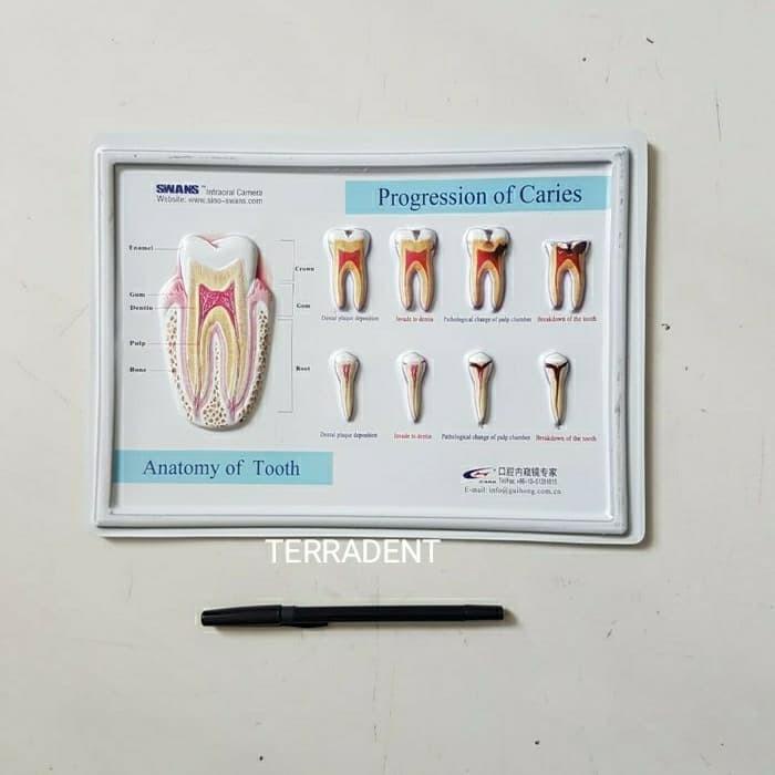 Jual Vier | Poster Gigi ( Progession Of Caries ) | Shopee Indonesia