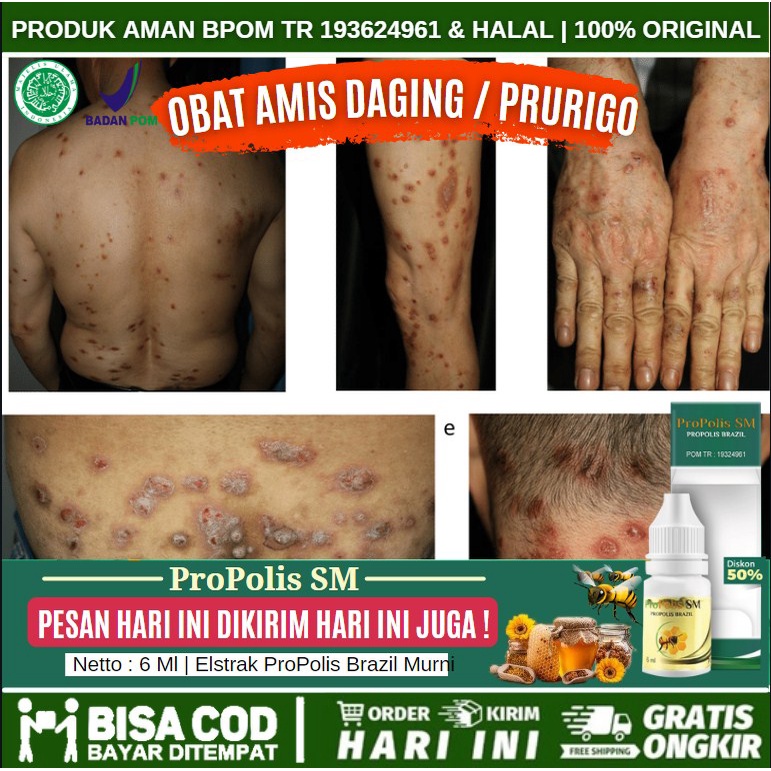 Jual Obat Penghilang Gatal Bentol Darah Manis, Gatal Prurigo, Pengering ...