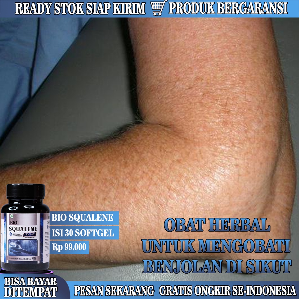 Jual Obat Benjolan Di Siku Tangan, Benjolan Tidak Sakit, Obat Benjolan ...