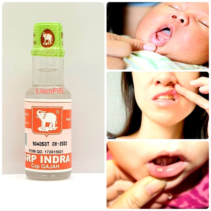 Jual Obat Sariawan Oles Syrup Indra Semua Usia, Bayi, Anak, Dewasa ...