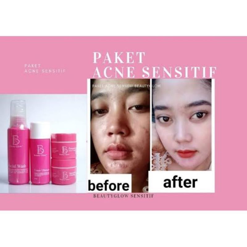 Jual BG skin / Beauty Glow skin / PAKET ACNE SENSITIVE LUXURY | Shopee ...