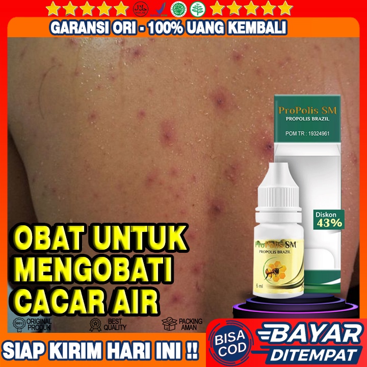 Jual Obat Cacar Air, Obat Tetes Cacar Air, Obat Oles Cacar Air, Obat ...