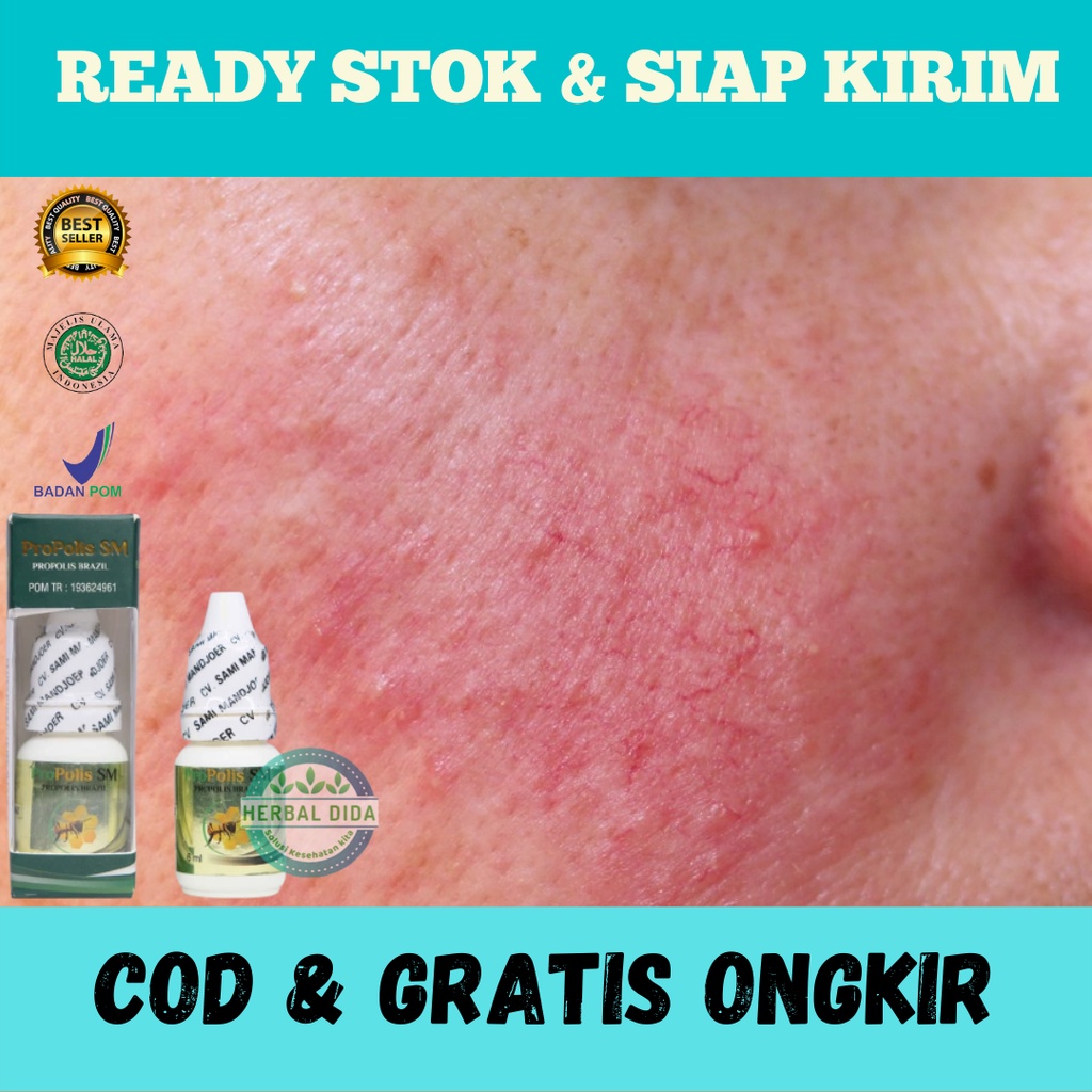 Jual Obat Herbal Anti Spider Veins, Obat Tetes Spider Veins ( Urat muka ...