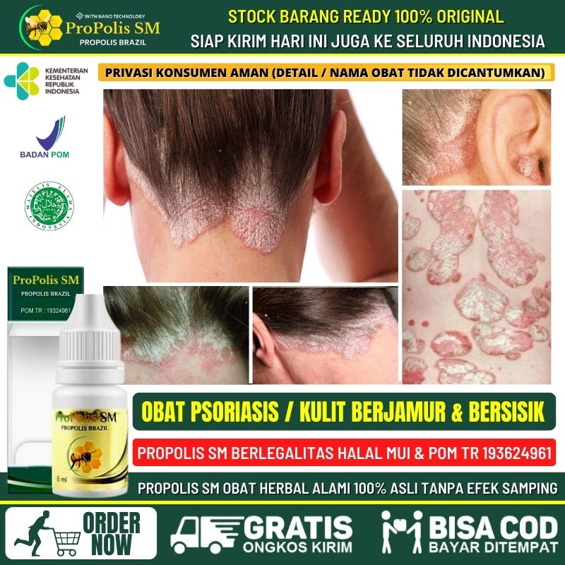 Jual Obat Tetes Psoriasis Kulit Kepala 100% Alami Tanpa Efek Samping ...