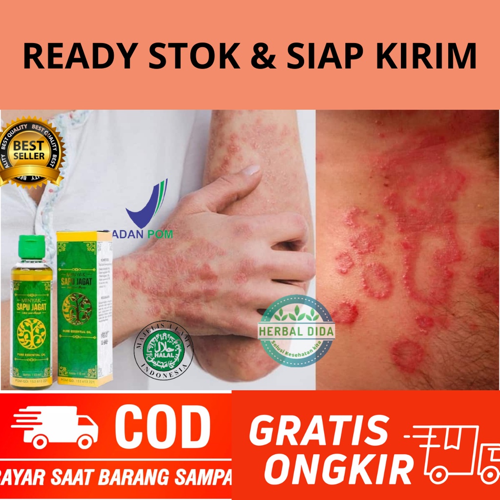 Jual Obat oles Obat Alergi , gatal, gatel, biduran, kaligata, Obat ...
