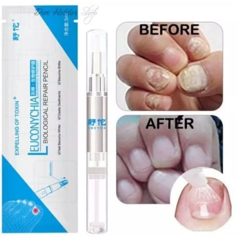 Jual OBAT JAMUR KUKU REPAIR NAIL KUKU PECAH-PECAH ANTIBAKTERI | Shopee ...
