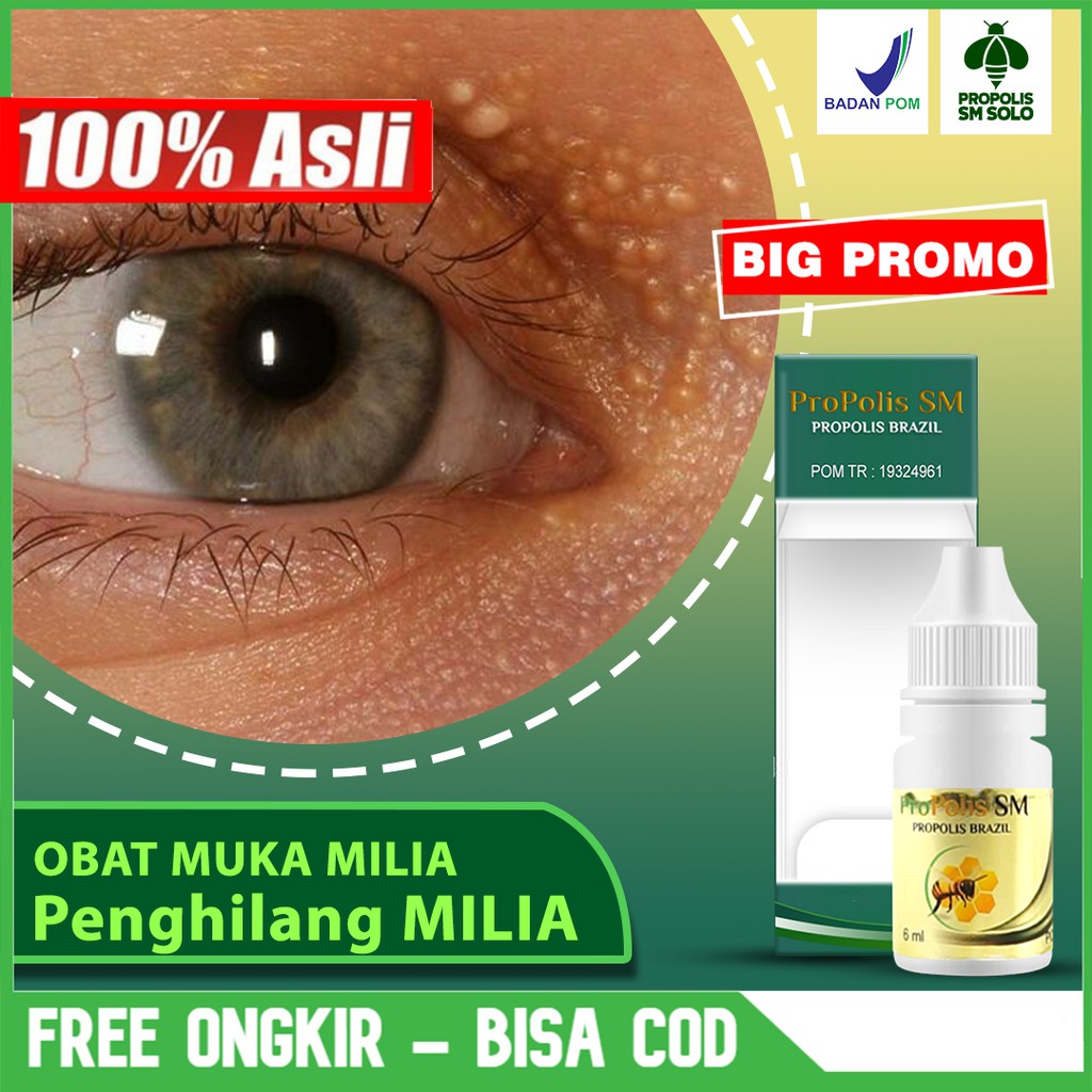 Jual Obat Muka Milia, Milea, Penghilang Milia di Wajah Propolis SM ...