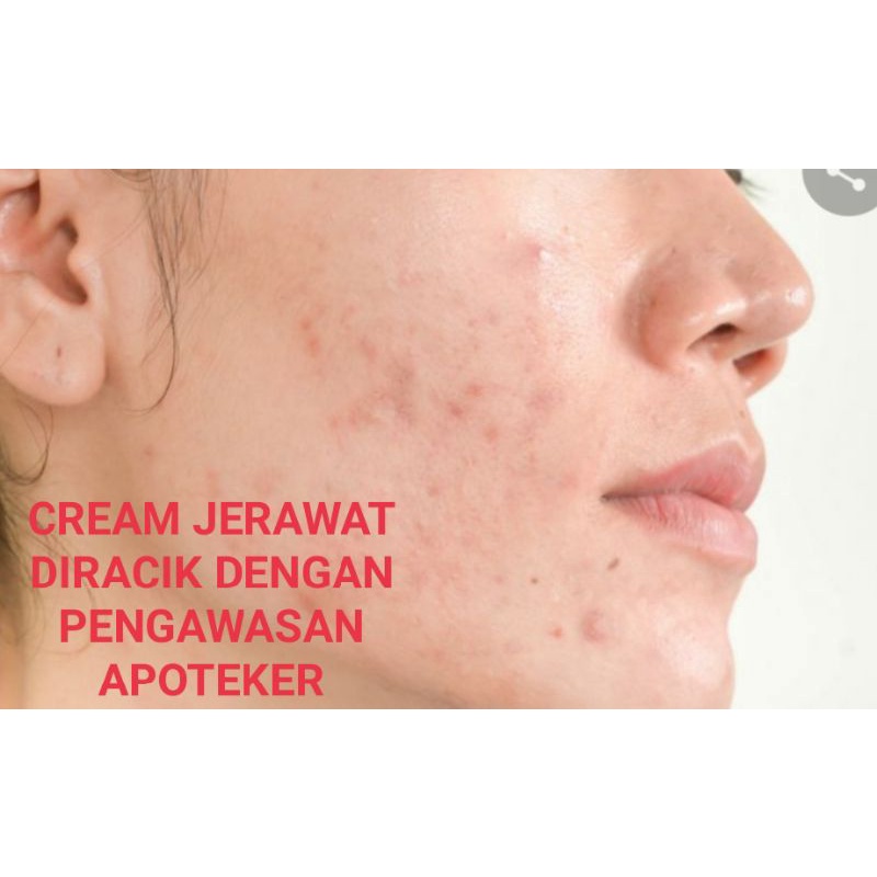 Jual cream jerawat racikan apoteker | Shopee Indonesia