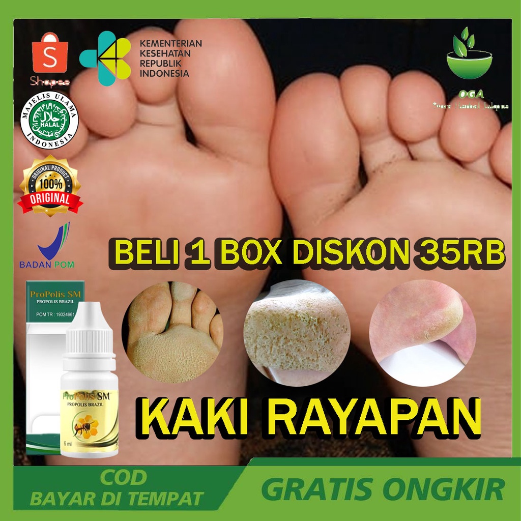 Jual Obat Kaki Rayapan Berlubang Telapak Kaki Kasar Kering Kaki Rematik ...