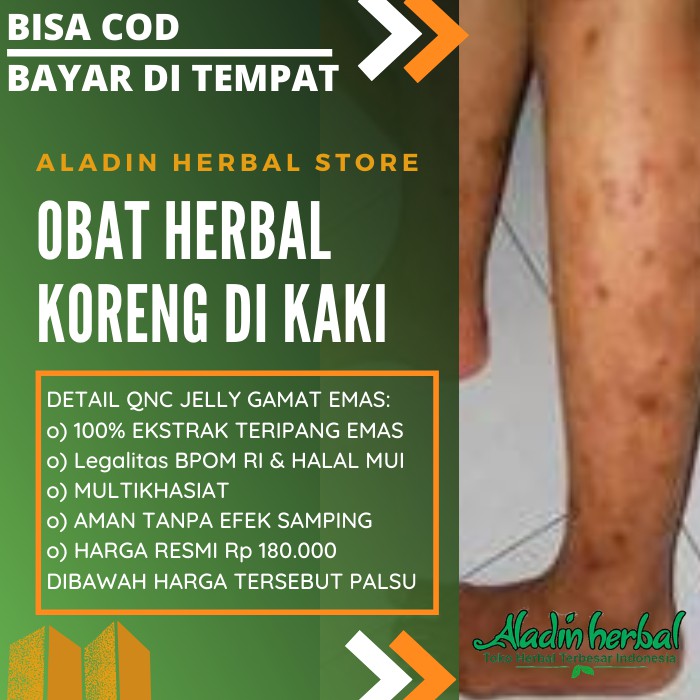 Jual [ COD ] - Obat koreng di kaki - Khusus korengan Menahun, Budug ...