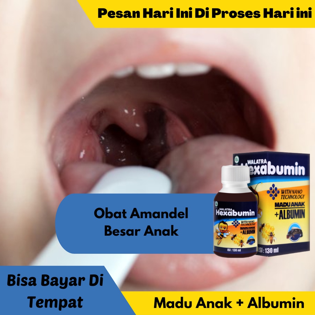 Jual Obat Amandel Besar Anak , Tonsilitis Akut , Sakit Tenggorokan , Batuk Terus Menerus ...