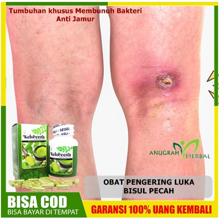 Jual Obat Pengering Luka Bisul Pecah, Herbal Kapsul Bisul Bernanah ...