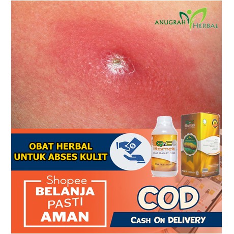 Jual Obat Abses Kulit - Penghilang Infeksi Jarum Suntik / Pembengkakan ...