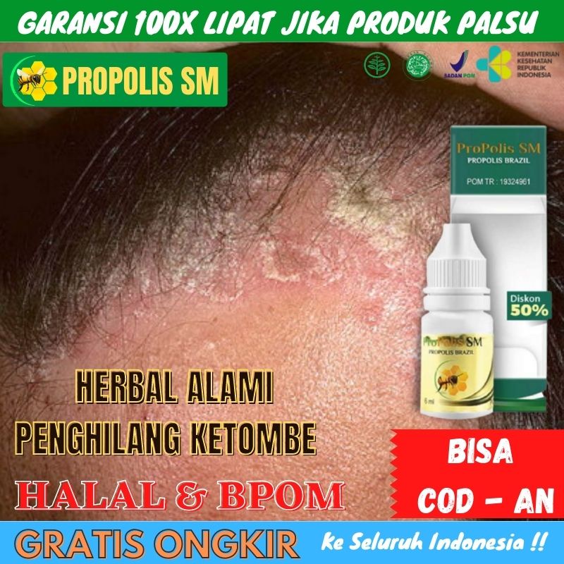 Jual Obat Penghilang Ketombe Berkerak Parah - Ketombe Basah - Ketombe Bersisik - Ketombe Sampai ...