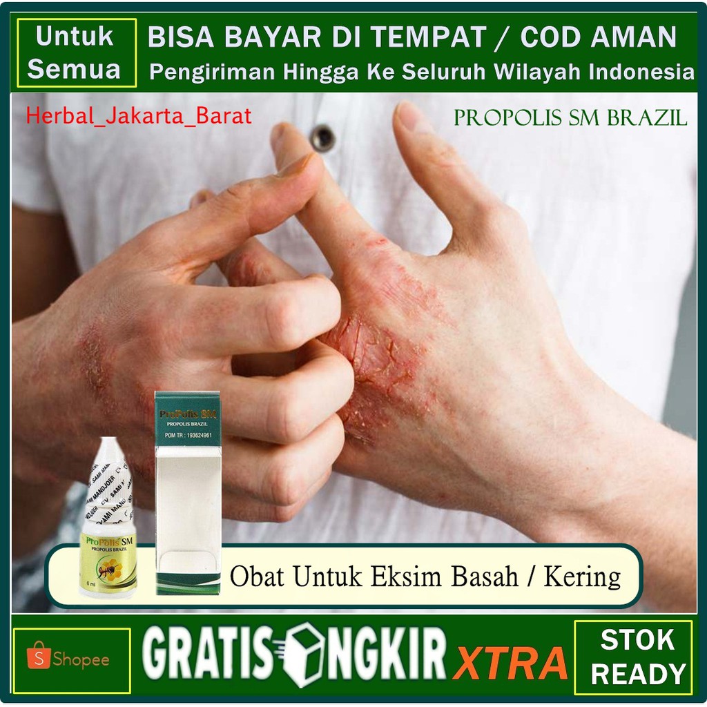 Jual ProPolis SM Brazil - Obat Tetes / Oles Untuk Eksim Kering, Eksim ...