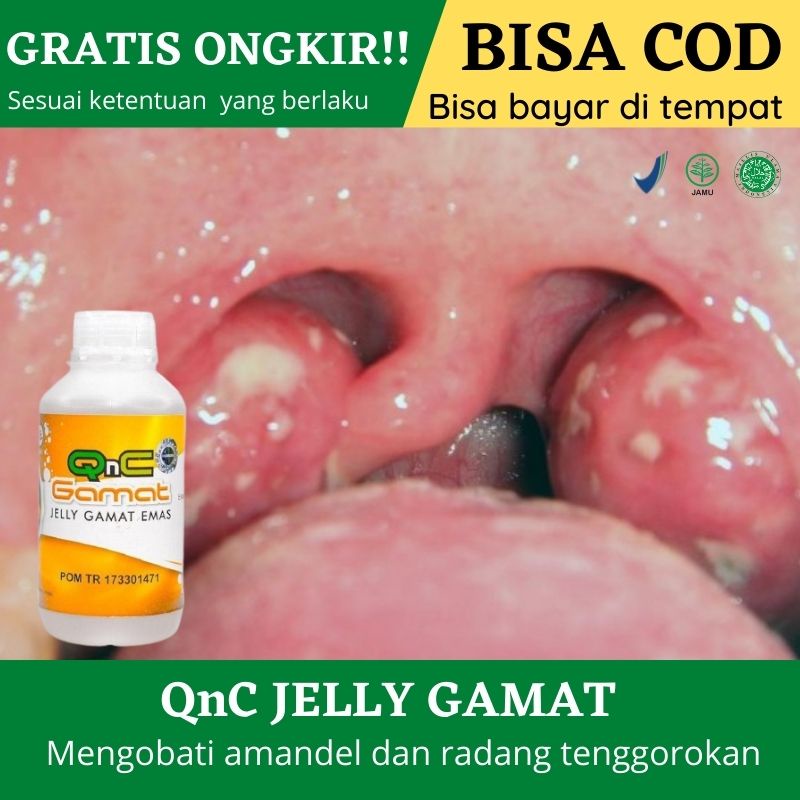 Jual Obat Penyakit Radang Tenggorokan - Obat Infeksi HIV - Tonsillitis ...