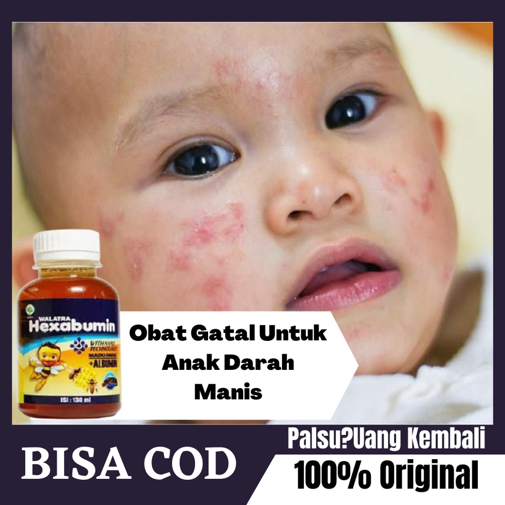 Jual Obat Gatal Untuk Anak Darah Manis , Prurigo , Obat Penghilang ...