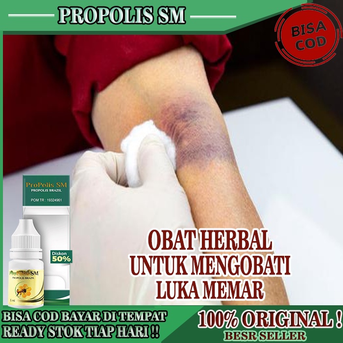 Jual Obat Luka Dalam Memar, Obat Luka Memar Untuk Anak & Dewasa, Obat ...