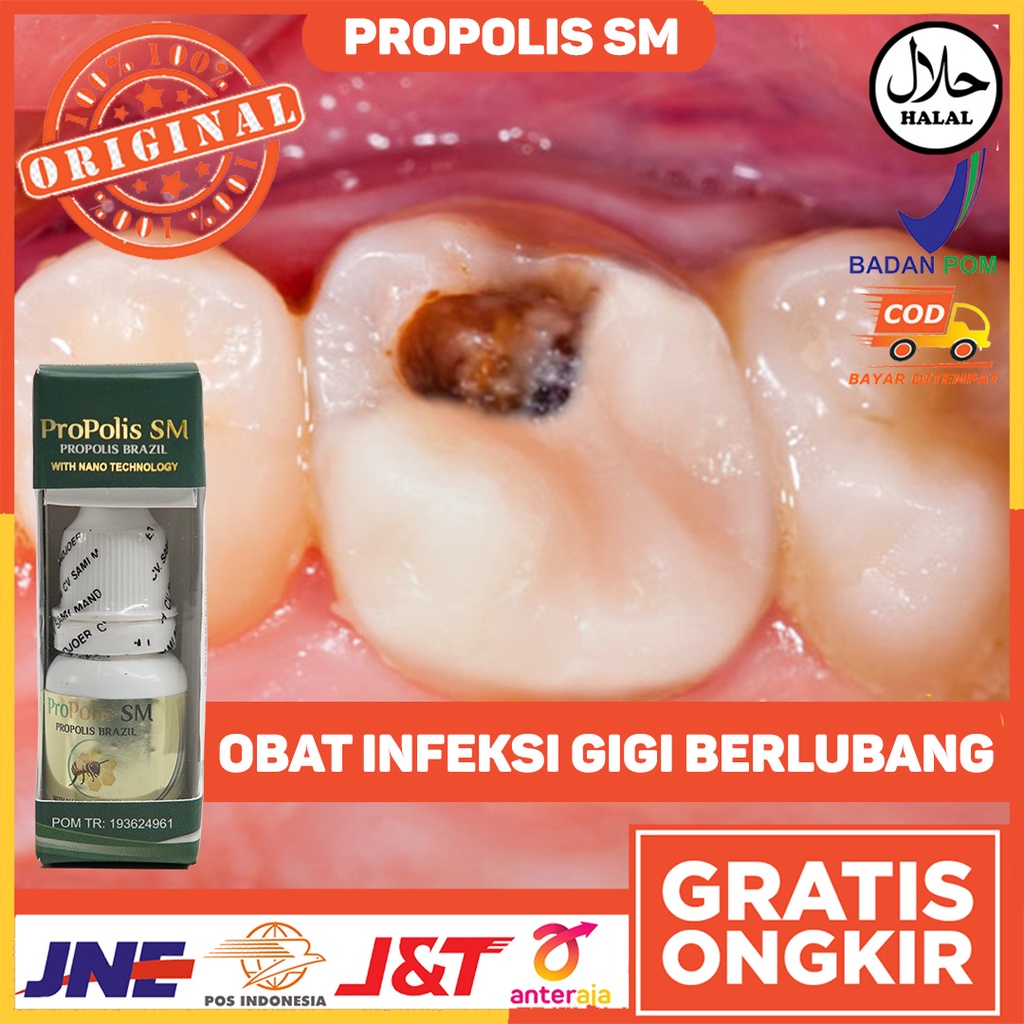Jual Obat Infeksi Gigi Berlubang Gusi Bengkak Gusi Berdarah Gigi Berlubang Abses Gigi - Propolis ...
