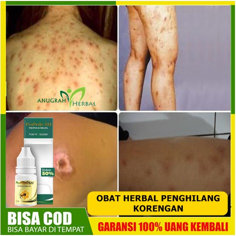 Jual Obat Penghilang Koreng - Obat Koreng di Kaki, Punggung Korengan ...