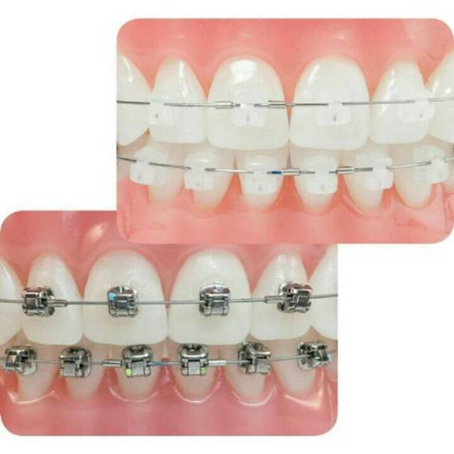 Jual Bracket self ligating ceramic bracket damond system transparan ...