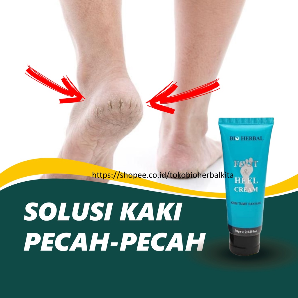 Jual Obat Tumit Pecah Dan Kering Ampuh B10P | Shopee Indonesia