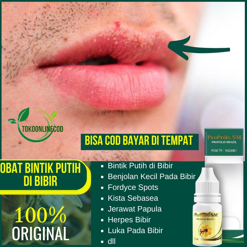 Jual Obat Penghilang Bintik Putih di Bibir, Obat Oles Benjolan Kecil ...