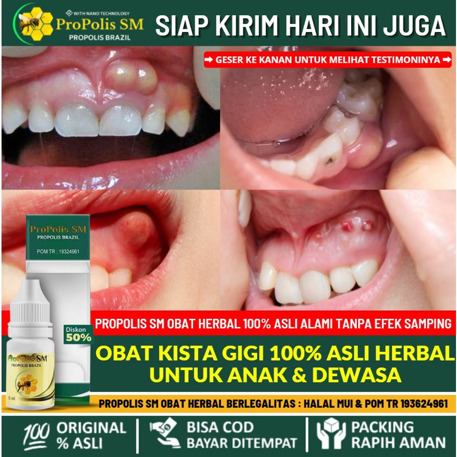 Jual Obat Kista Gigi Anak & Dewasa 100% Alami, Infeksi Akar Pada Gigi ...