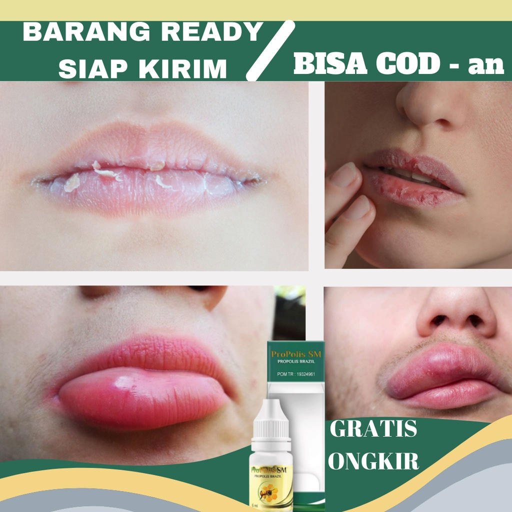Jual Obat Bibir Bengkak, Obat Bibir Pecah dan Kering, Sariawan Bibir ...