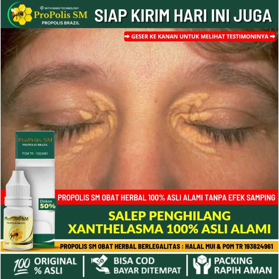 Jual Obat Lemak di Kelopak Mata, Obat Oles Xanthelasma, Obat Santelasma ...