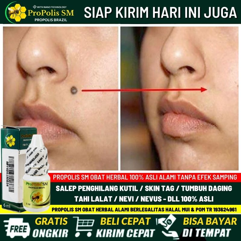 Jual AMAN BPOM - Salep Perontok Kutil, Salep Perontok Tahi Lalat Hidup ...