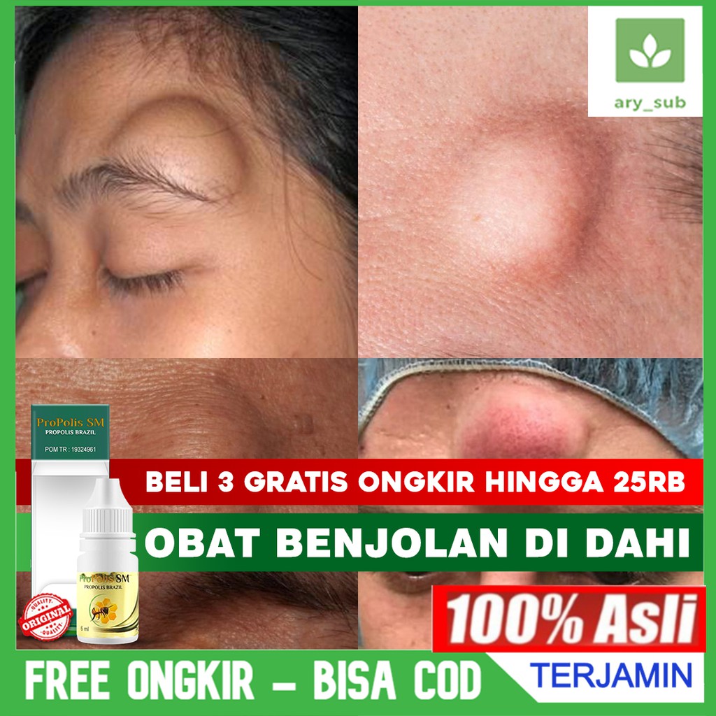Jual Obat Benjolan di Dahi Kiri Kanan - Benjolan di Jidat Kiri Kanan ...