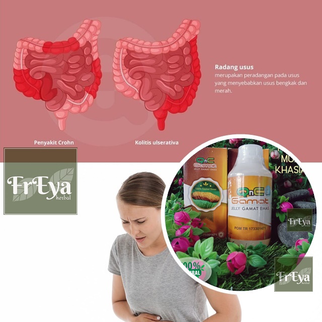 Jual OBAT RADANG USUS, OBAT HERBAL INFLAMMATORY BOWEL DISEASE, OBAT ...