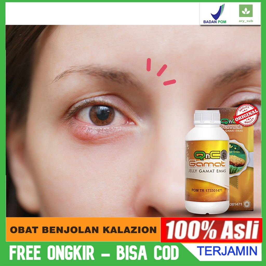 Jual Obat Kalazion Benjolan Pada Kelopak Mata - Mata Sakit Herbal Alami ...
