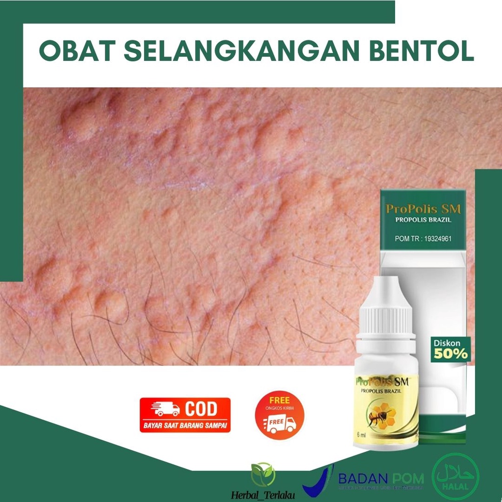 Jual Obat Bentol Bentol Di Selangkangan , Gatal , Benjolan Kecil ...