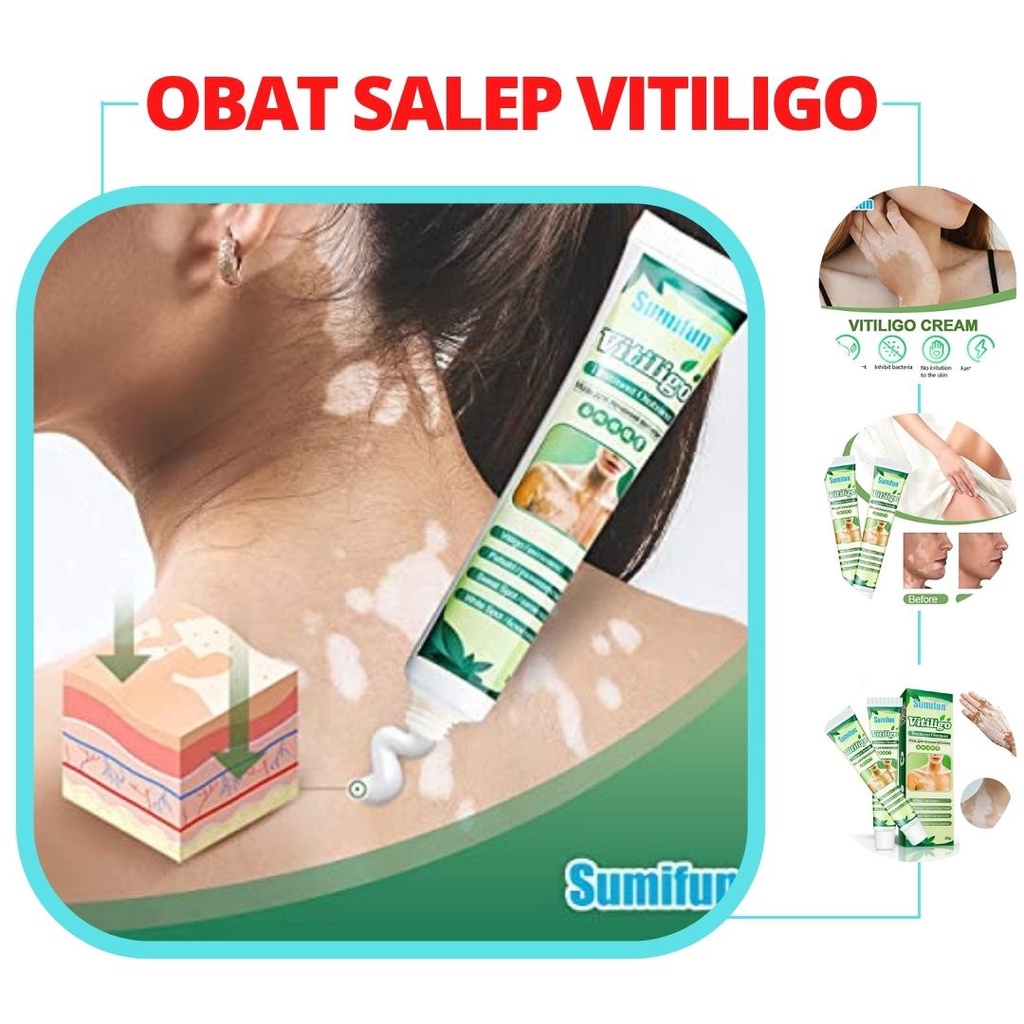 Jual OBAT SALEP VITILIGO BERCAK PUTIH / KULIT BELANG Putih KRIM ...