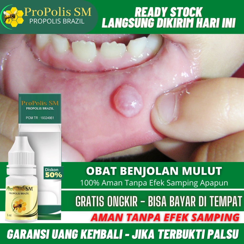 Jual Obat Penghilang Benjolan di Lidah / Mulut / Bibir, Obat Benjolan ... Jual Obat Penghilang Benjolan di Lidah / Mulut / Bibir, Obat Benjolan ...
