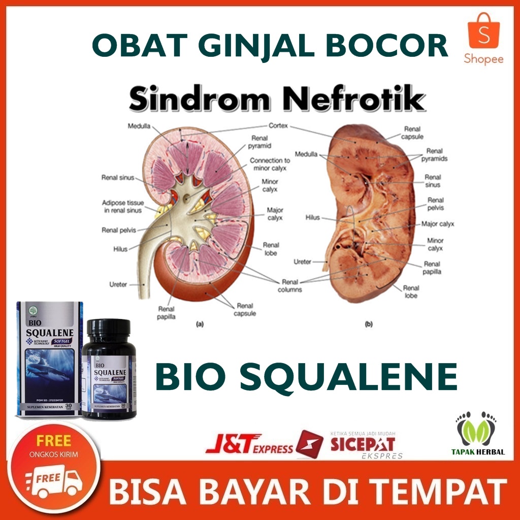 Jual Bio Squalene - Obat Ginjal Bocor, Sindrom Nefrotik, Bocor Ginjal ...