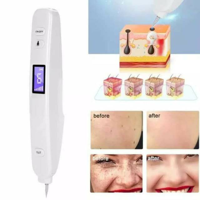 Jual Dark spot couter pen tatto kutil, tahi lalat dll | Shopee Indonesia